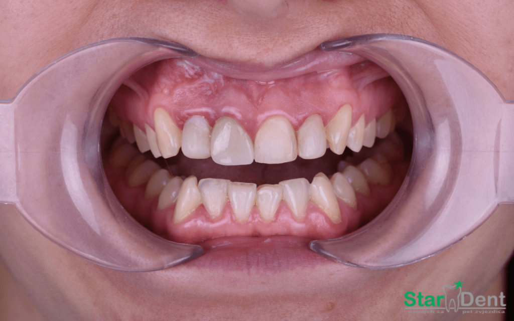 CIRKONSKI ZUBI - StarDent